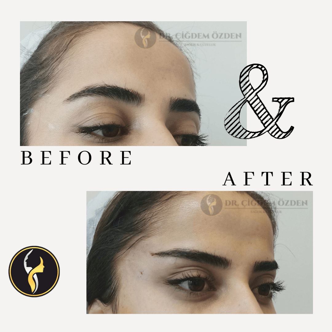 Fox Eyes Istanbul | Non Surgical Eyebrow Lift | Dr. Çiğdem Özden
